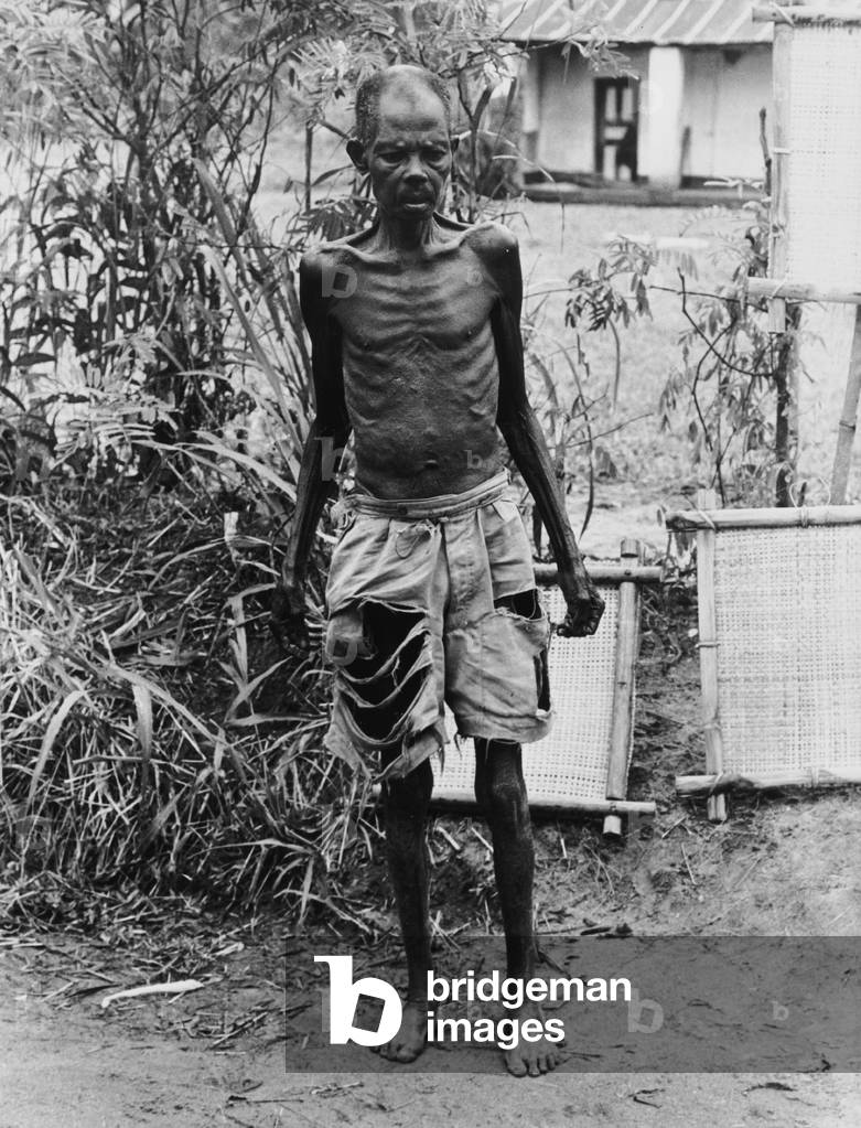 Image of Homme souffrant de malnutrition dans un camp de réfugiés au