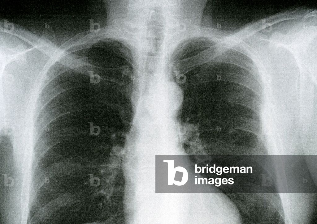 Image of Radiography of the human thorax, 2024 (photo) by Cartier, Patrice