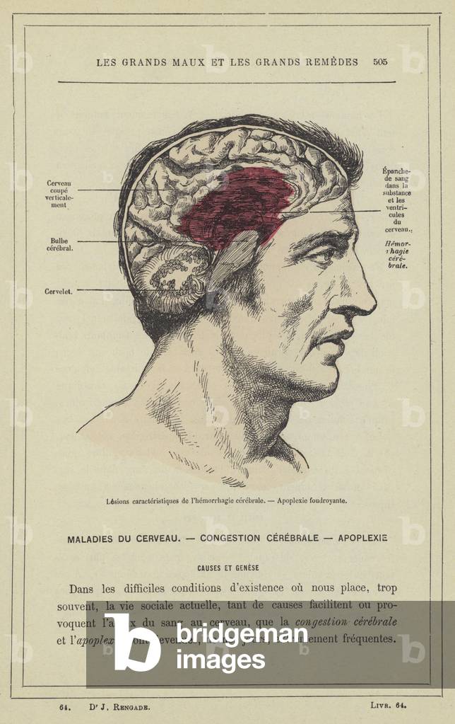 Image of Lesions caracteristiques de l'hemorrhagie cerebrale, Apoplexie ...