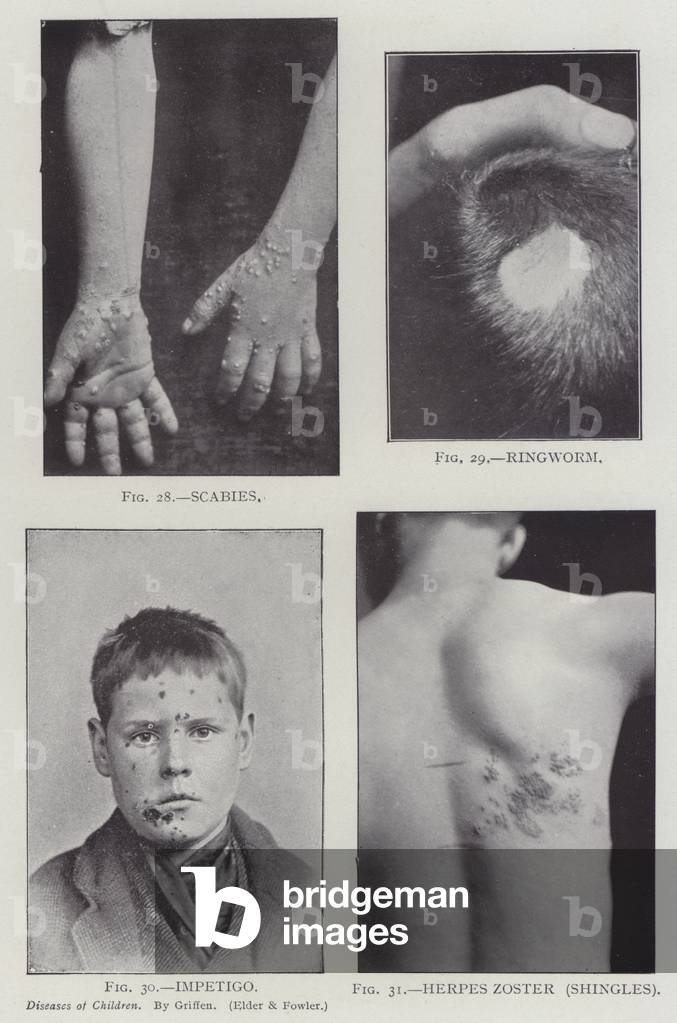 Image of Scabies, Ringworm, Impetigo, Herpes Zoster, Shingles (b/w ...